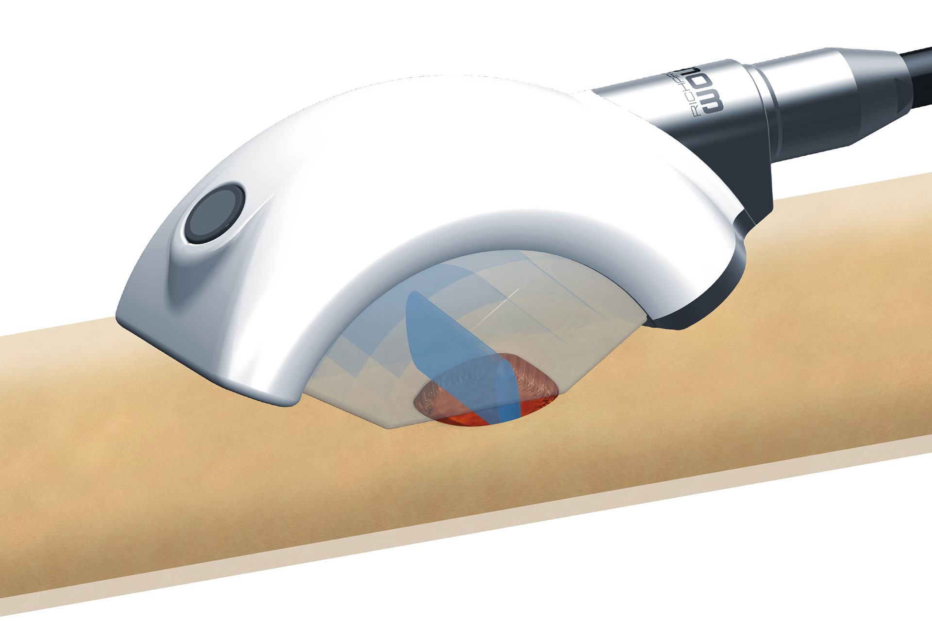 Wundheilungsmanagement EWST | Urologische Privatpraxis Dr. med. univ. Tosev